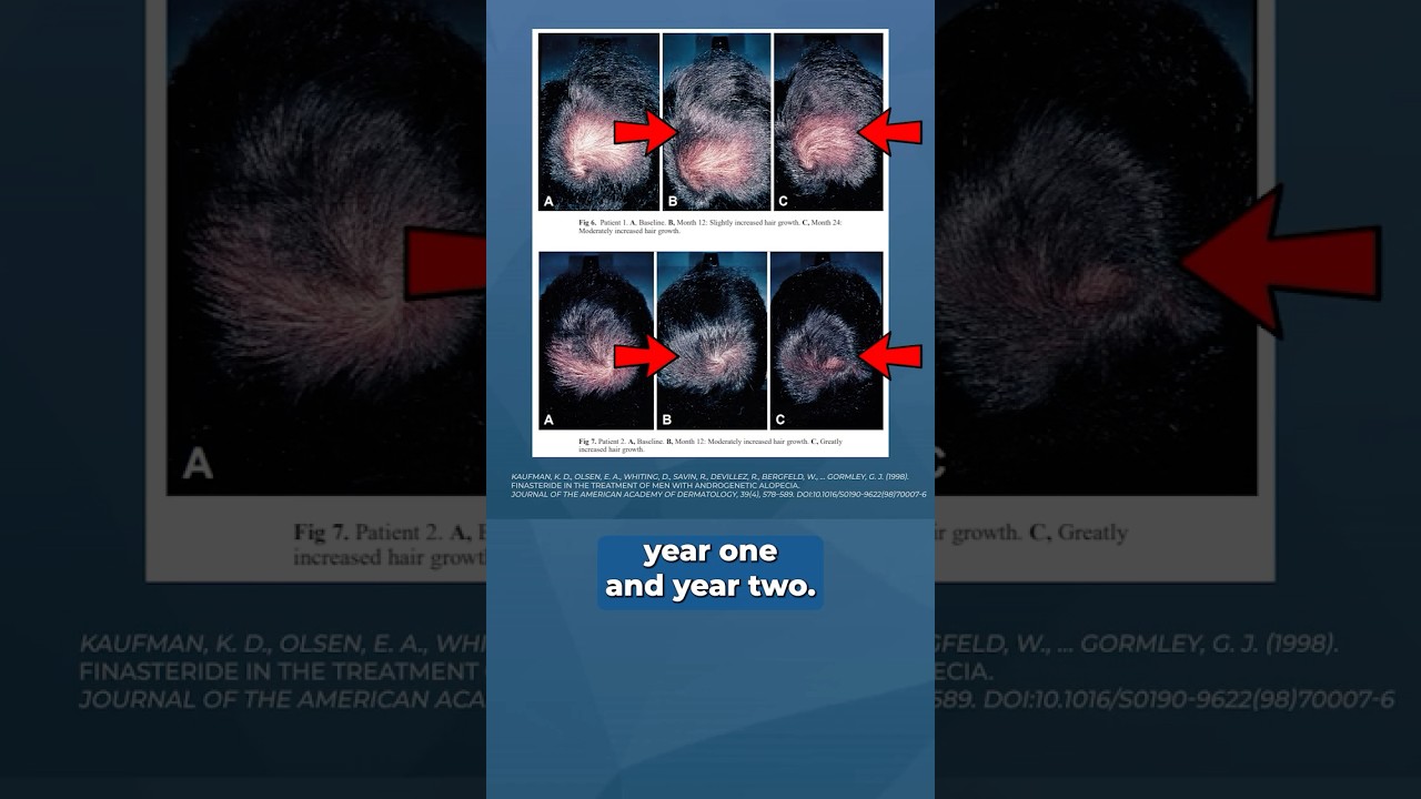 Why Finasteride Needs MORE Time to Work ⏰
