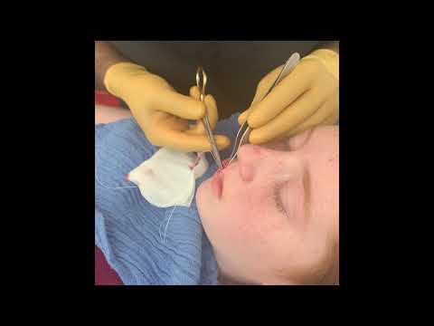Lip Laceration Repair