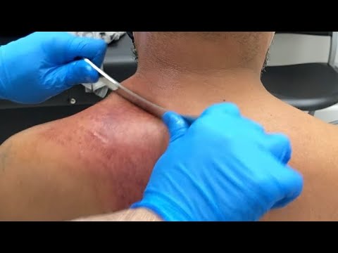 CHIROPRACTIC TREATMENT FOR SHOULDER PAIN | CHIROPRACTIC ADJUSTMENTS CRACKS | YSTRAP ADJUSTMENT