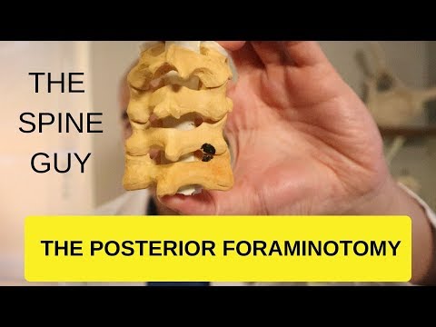 CERVICAL STENOSIS RADICULOPATHY - PART 4 - THE POSTERIOR FORAMINOTOMY