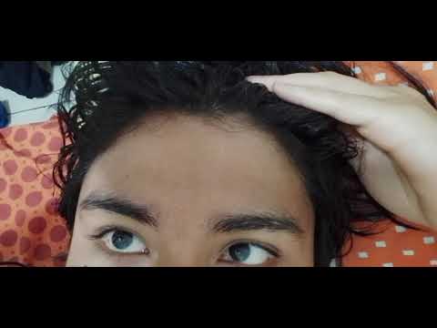 HOW I cured my seborrheic dermatitis (My experience with extreme treatment)