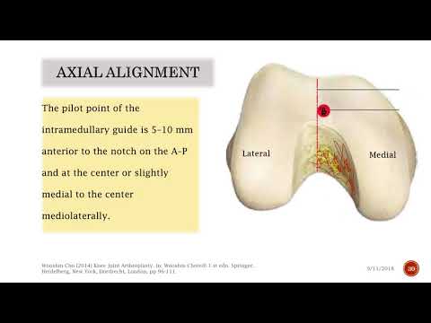 TKA Coronal Plane Balancing - Recon - Orthobullets