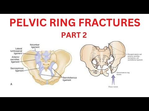 PELVIC RING FRACTURES PART -2, EPISODE 2