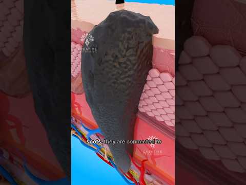 Why You Should NEVER Cut Off a Mole at Home! #short #mole - Creativelearning3d