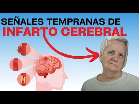 10 signs you will have a stroke