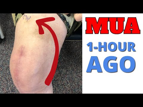 Manipulation Under Anesthesia 1-Hour AGO * Physical Therapy
