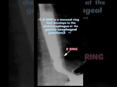 22-🎯👉B-RING (SCHATZKI RING IF SYMPTOMATIC ) 🌺IN BARIUM ESOPHAGOGRAPH