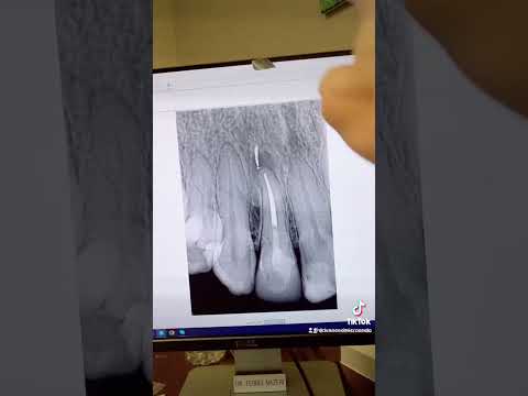 Don’t listen to clinicians who tell you to go to apico right away!