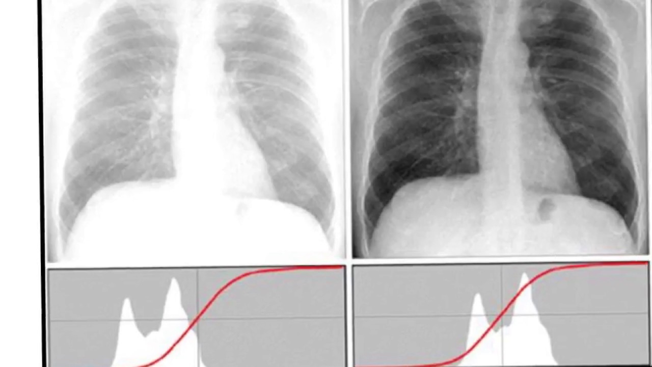 IG: Digital Radiography Exposure Indicators (Part 1)