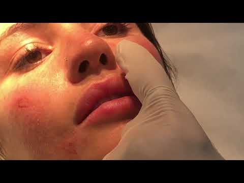 Fillers with Cannulas | Edgewater Med Spa, Weehawken NJ with Dr Taj Khan