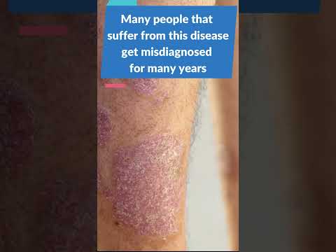 Can Psoriasis cause Arthritis? Learn about Psoriatic Arthritis!