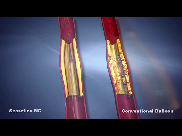 Balloon Catheter - Terumo Accuforce PTCA Dilatation Catheter Wholesale ...