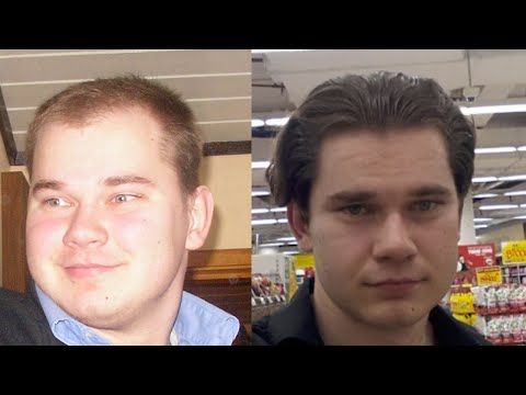 Topical Finasteride 4 Week Regrowth Results On Hairline Area