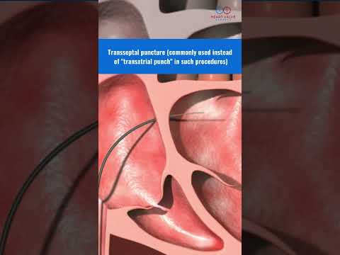 Step-by-Step Guide to Left Atrial Appendage Closure (Watchman Procedure)