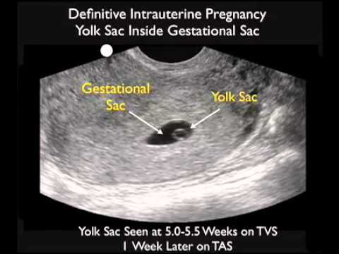How To: OB Ultrasound - Normal Pregnancy Case Study Video