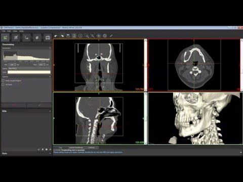 Mandible segmentation for 3D printing