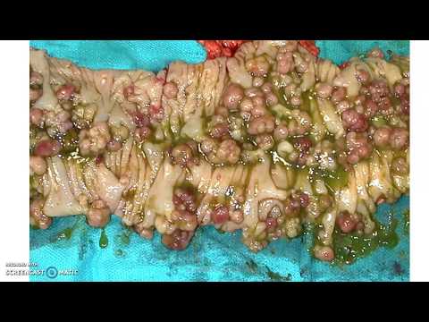 COLORECTAL POLYPS