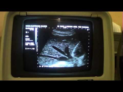 congestive liver