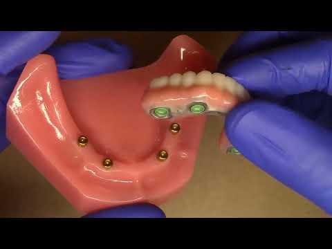 How to Place a LOCATOR FIXED Prosthesis with Dr. Michael Scherer