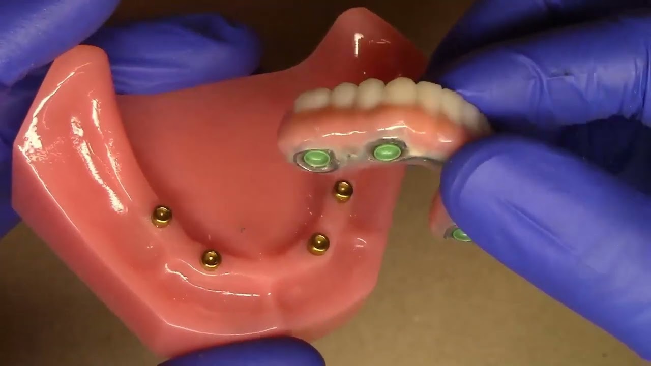 How to Place a LOCATOR FIXED Prosthesis with Dr. Michael Scherer