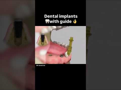 Top U.S. Dental Lab for advanced implant restorations & full-arch solutions! 🏆