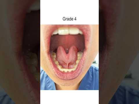 Tongue Tie: Severity Grades 1-4 (Tongue Range of Motion Ratio)