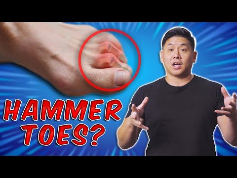 Hammer Toes / Claw Toes Fixed at Home! Physical Therapist Teaches
