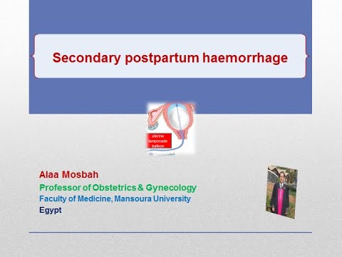 Secondary postpartum haemorrhage