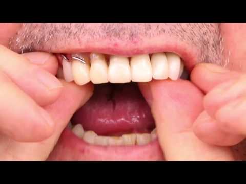 Partial Denture Video
