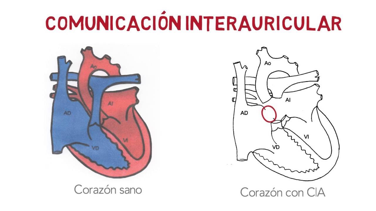 ASD - Atrial septal defect