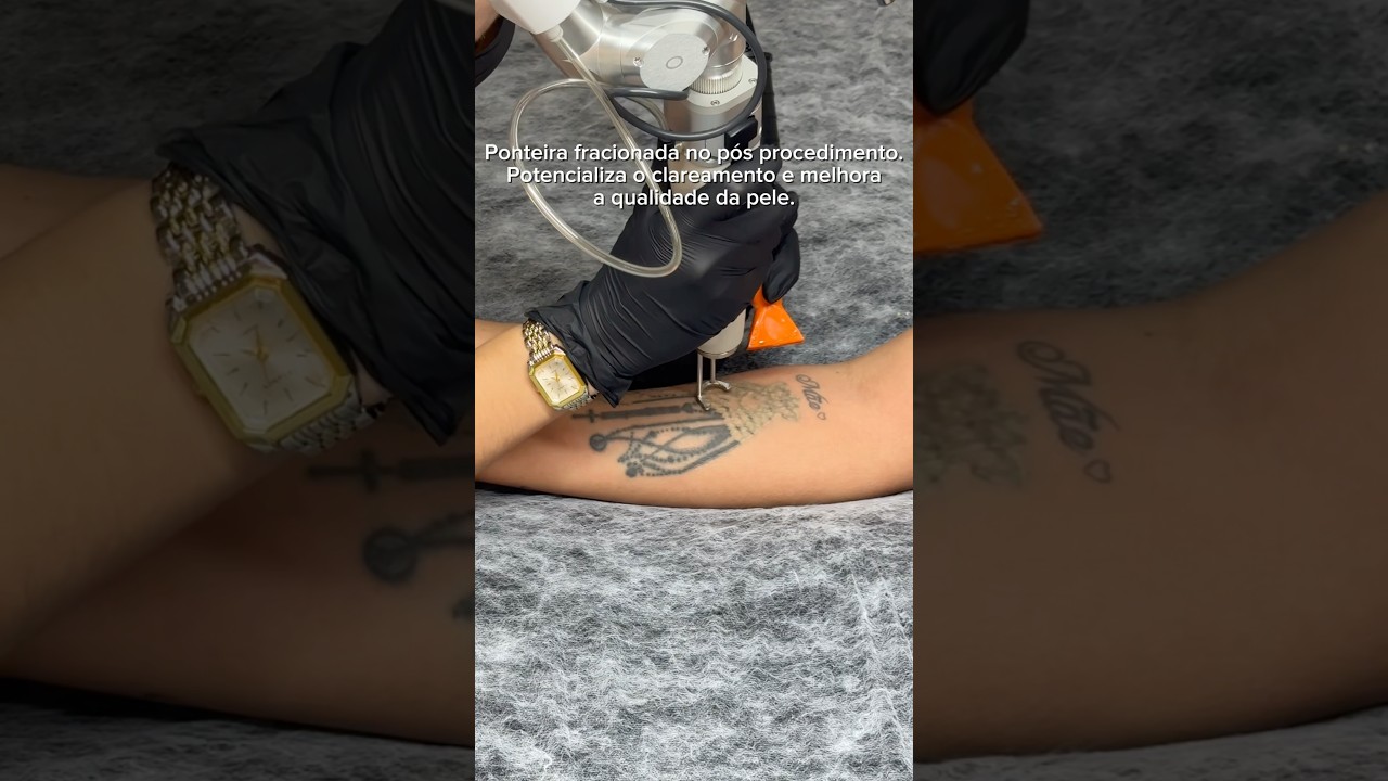 Primeira sessão remoção de tatuagem #lasertattoo #remocaodepigmentos