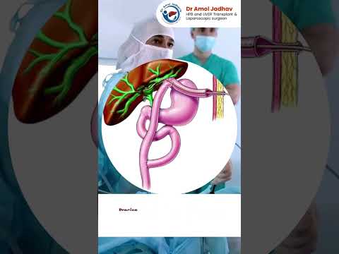 Laparoscopic Hepaticojejunostomy | Dr. Amol Jadhav | Best Liver Surgeon in Pune