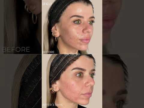 Halo Laser Treatment!