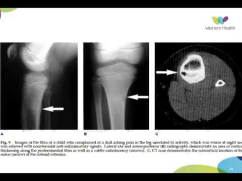 Benign Bone Tumors by Dr Daniel Sydenham