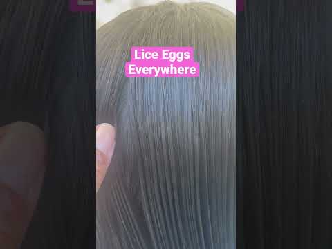 What lice eggs looks like in the hair l Lice Infestation @staceythelouselady