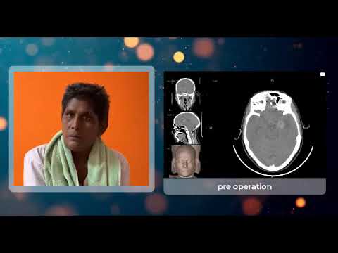 Best Neurosurgeon, Spine surgeon, Neurologist Guntur & INDIA