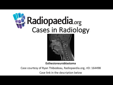 Esthesioneuroblastoma (Radiopaedia.org) Cases in Radiology