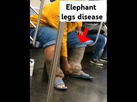 Lymphatic Filariasis