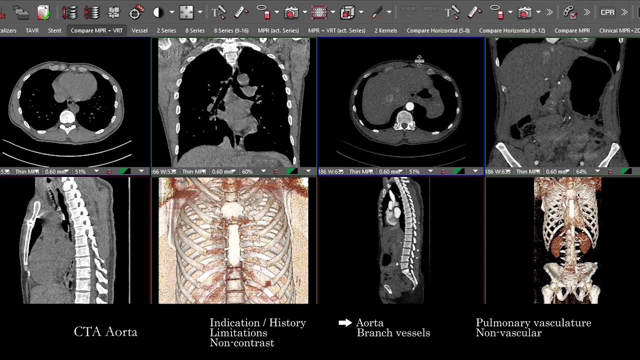 [CT] CTA Aorta | Search Pattern