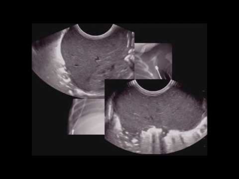 Pediatric Chest Ultrasound