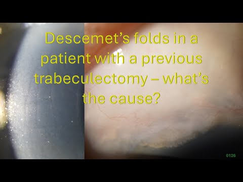 0126: Descemet's folds in a patient with a previous trabeculectomy