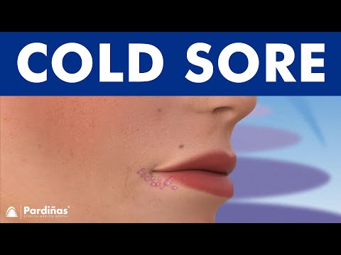 COLD SORES -  Causes and symptoms of herpes on lip © (8K)
