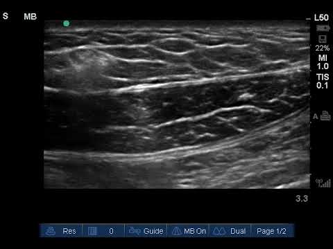 Abdominal Wall Pain: Trigger Point Injections