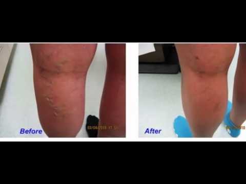 Sclerotherapy | Waterbury, CT (203) 574-0400
