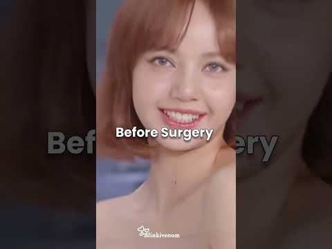 Proof that lisa got unnecessary plastic surgery#blackpink#lisa#Kpop