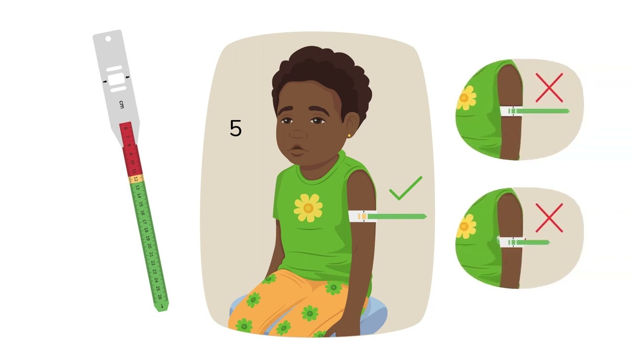 How to Identify Malnutrition in Children