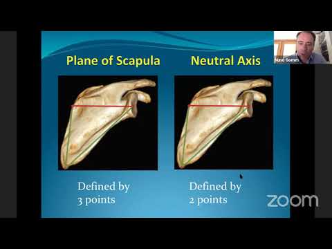 Role of Patient Specific Instrumentation in Shoulder Arthroplasty