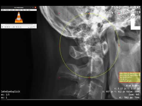 Prospective Patient Denied Free MRI Review! Dr. Scott Katzman Orthopedic & Laser Spine Surgery