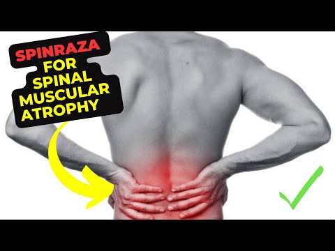 Spinraza Side Effects: Understanding the Benefits and Risks of this Life-Changing Treatment