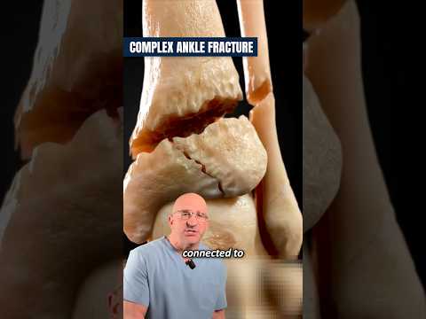 Do Ankle Fractures REALLY Need Plates & Screws⁉️ #shorts